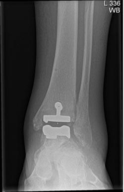 Ankle Replacement – South Downs Foot And Ankle Clinic